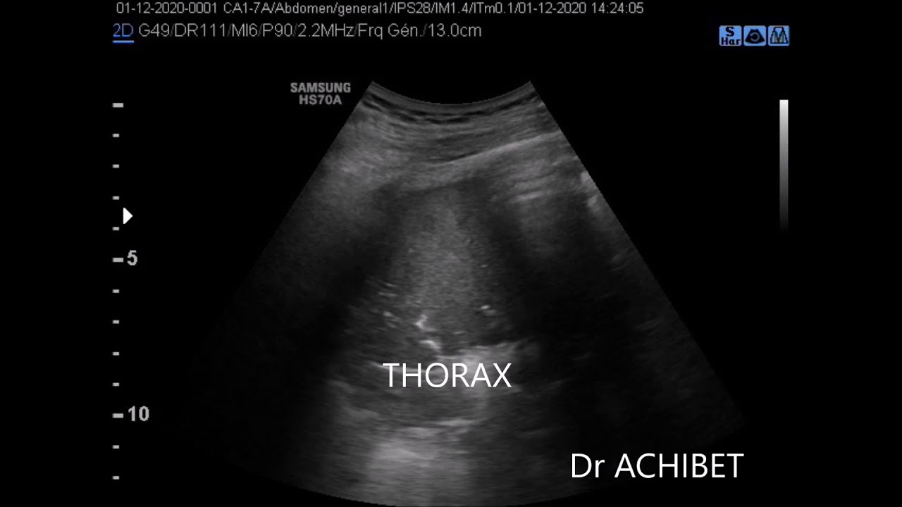 pneumopathie /hépatisation/échographie pleuro-pulmonaire - YouTube