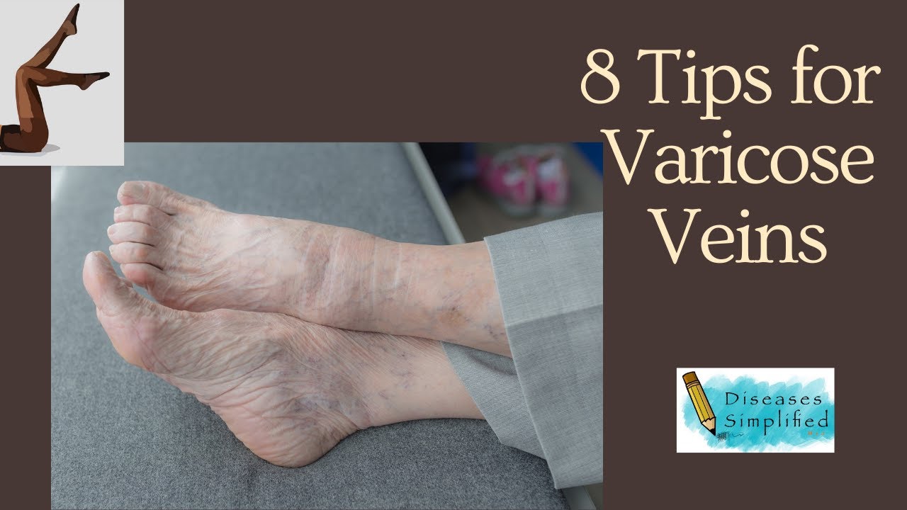 8 Tips for Varicose Veins - YouTube
