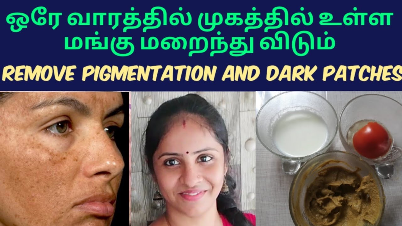 முகத்தில் உள்ள மங்கு ஒரே வாரத்தில் மறைந்து விடும் | How to reduce ...