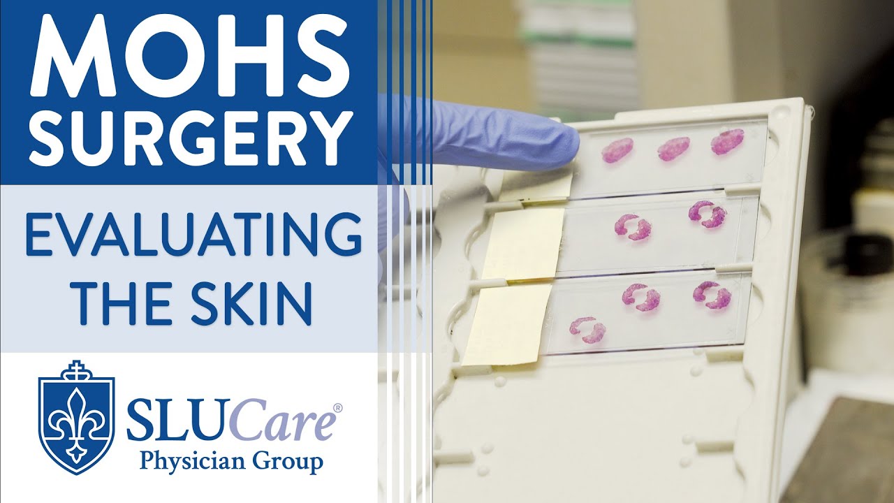 How skin is Processed and Evaluated During Mohs Surgery - YouTube