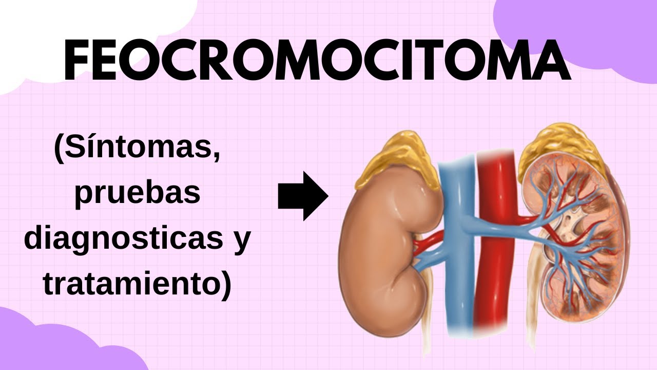 Que es el FEOCROMOCITOMA (Síntomas, pruebas diagnosticas y tratamiento ...