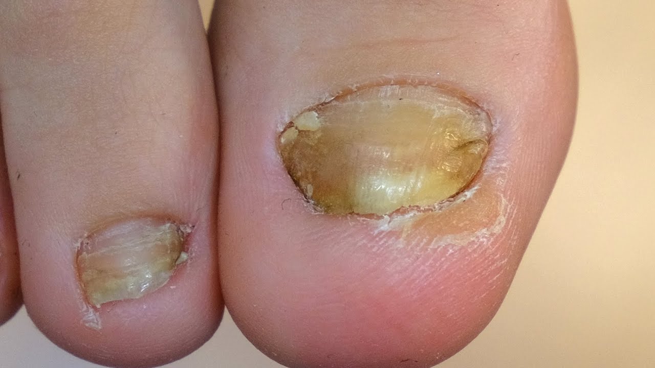 Deformed toenail in a child. Сonsequences of injury to the toenail. # ...