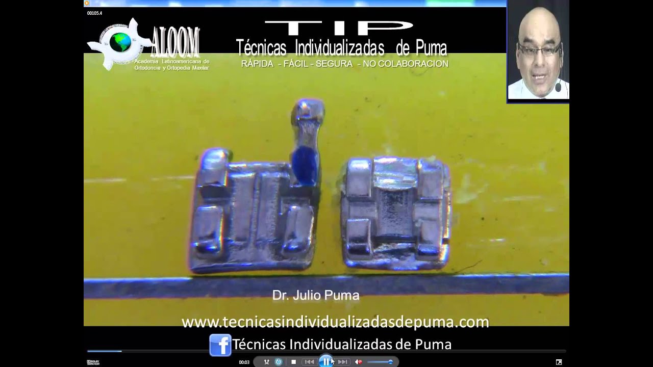 Brackets de Arco Recto Roth 1-3 Curso Virtual de Ortodoncia - YouTube