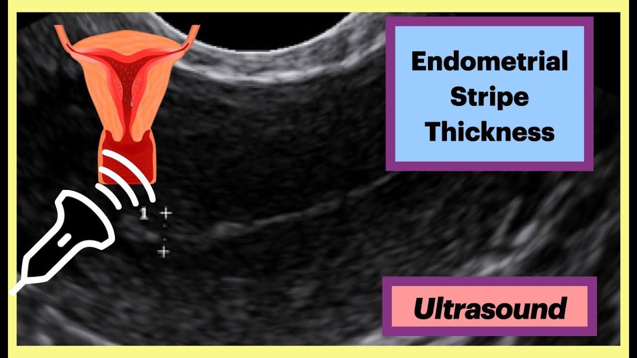 Pelvic Ultrasound for endometrial thickness and bleeding #gynecology # ...