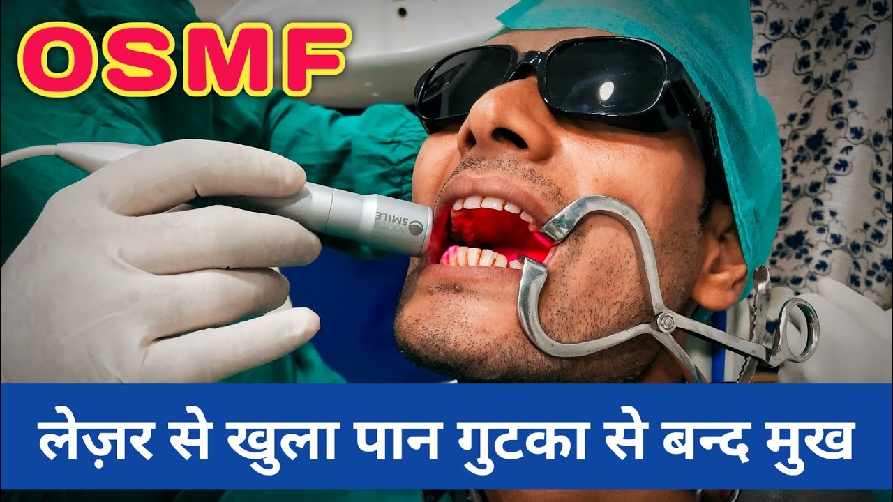 OSMF treated by Diode laser 3rd grade opening is 15 mm to 20 mm on 1st ...