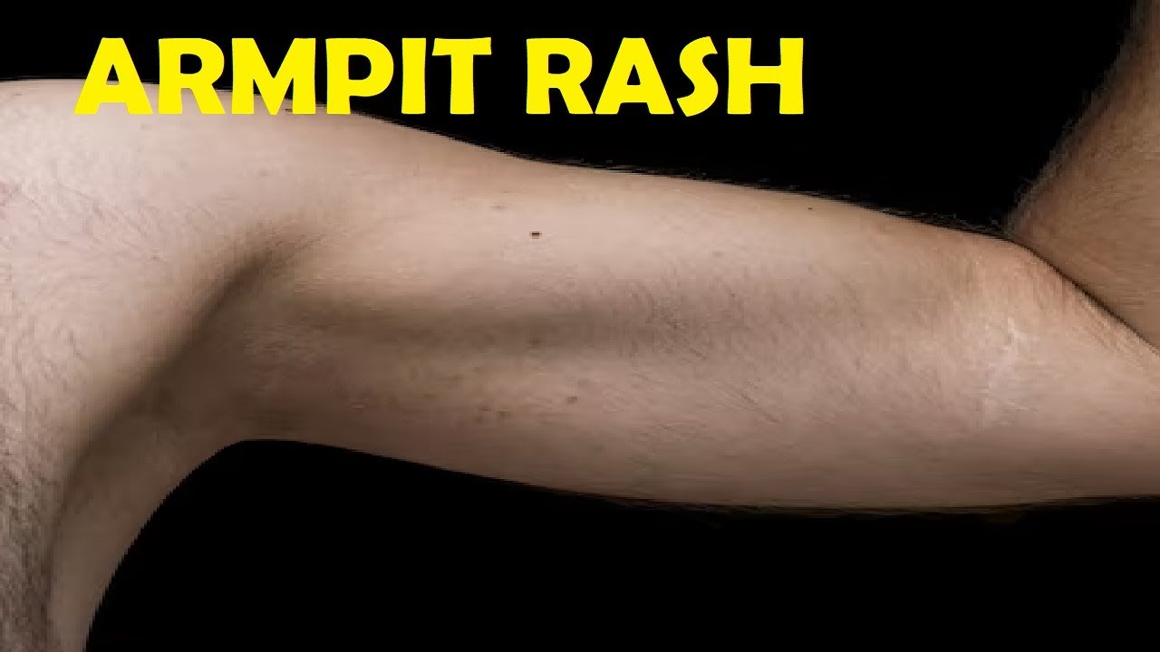 how to get rid of armpit rash from shaving - YouTube