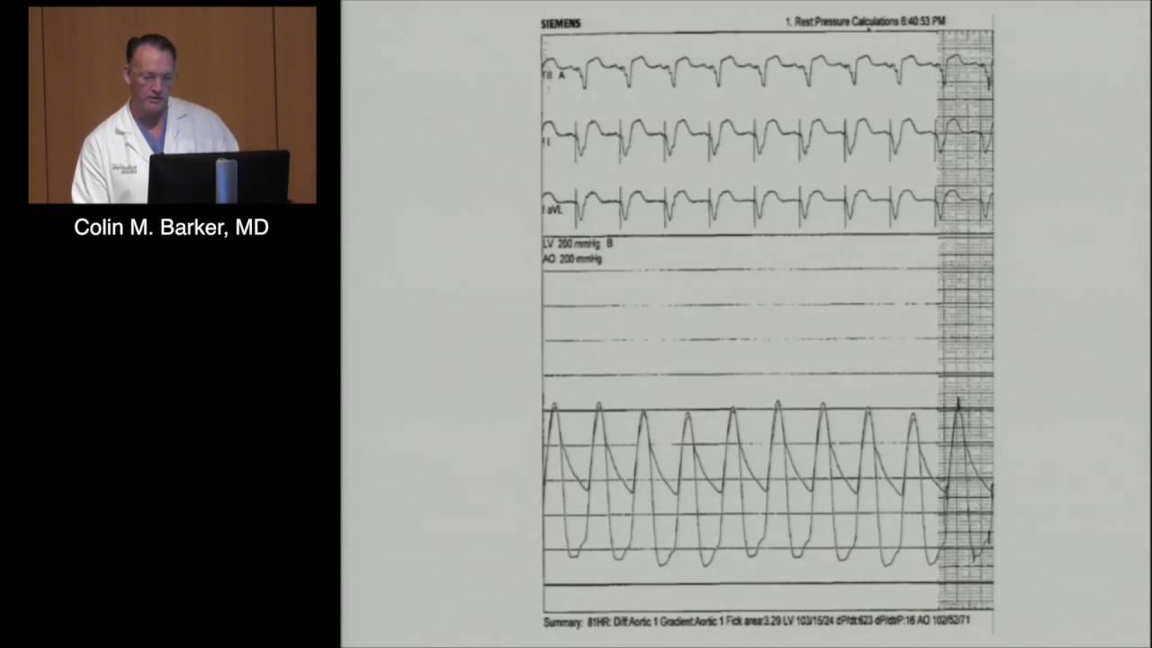 Invasive Hemodynamics: Where Catheters Still Rule (Collin Barker, MD ...