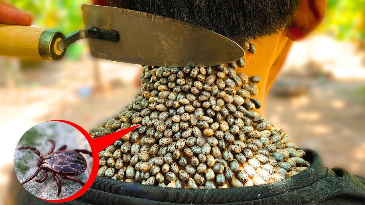 Crazy ticks infection on human - YouTube