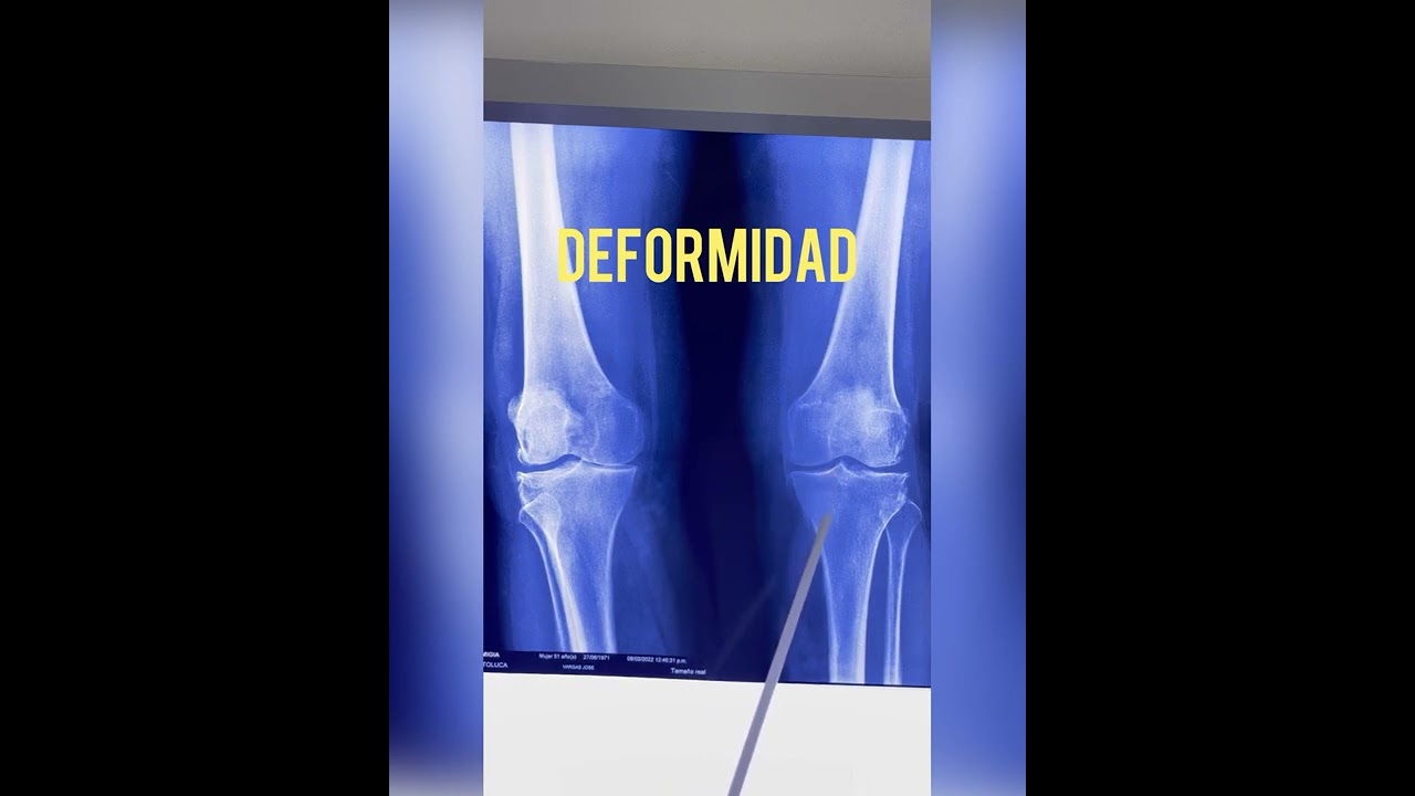 Hallazgos radiográficos del desgaste de rodillas. - YouTube