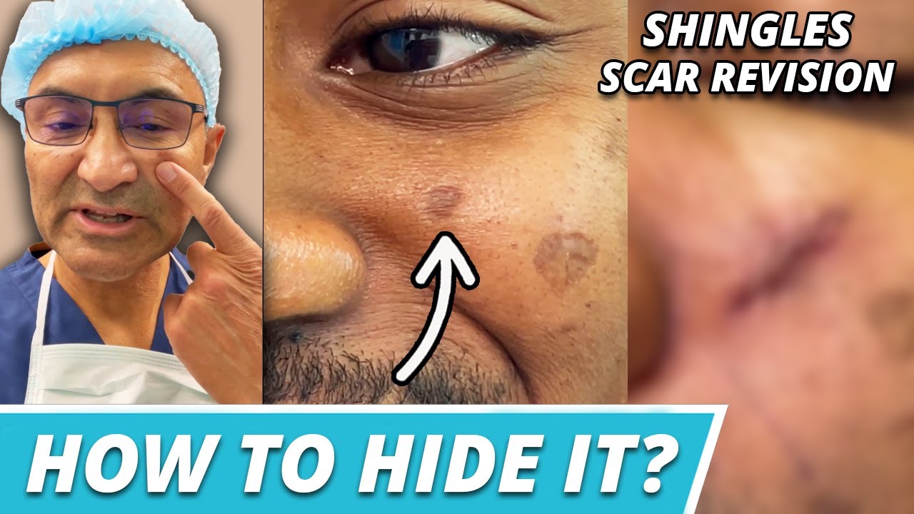 Can Dr. Janjua hide this shingles scar? | Scar Revision - YouTube