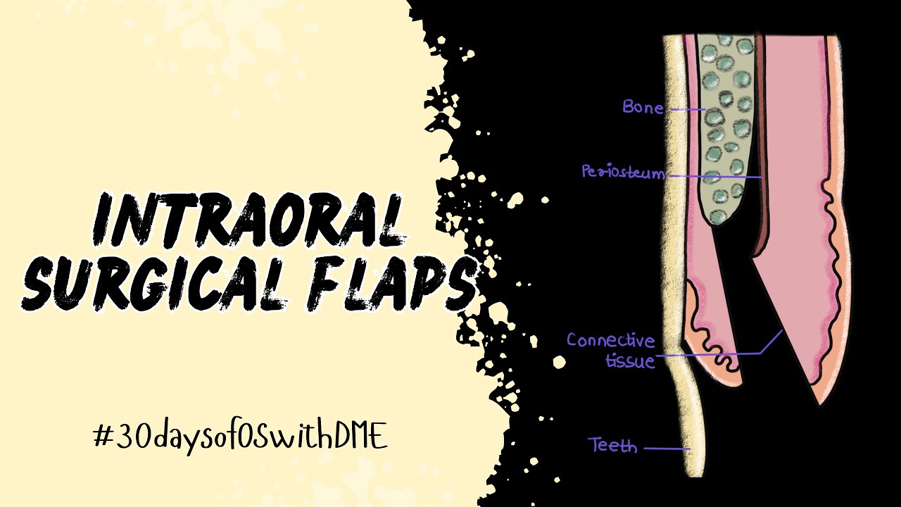 INTRAORAL SURGICAL FLAPS || 3 different types || 30daysofOSwithDME - YouTube