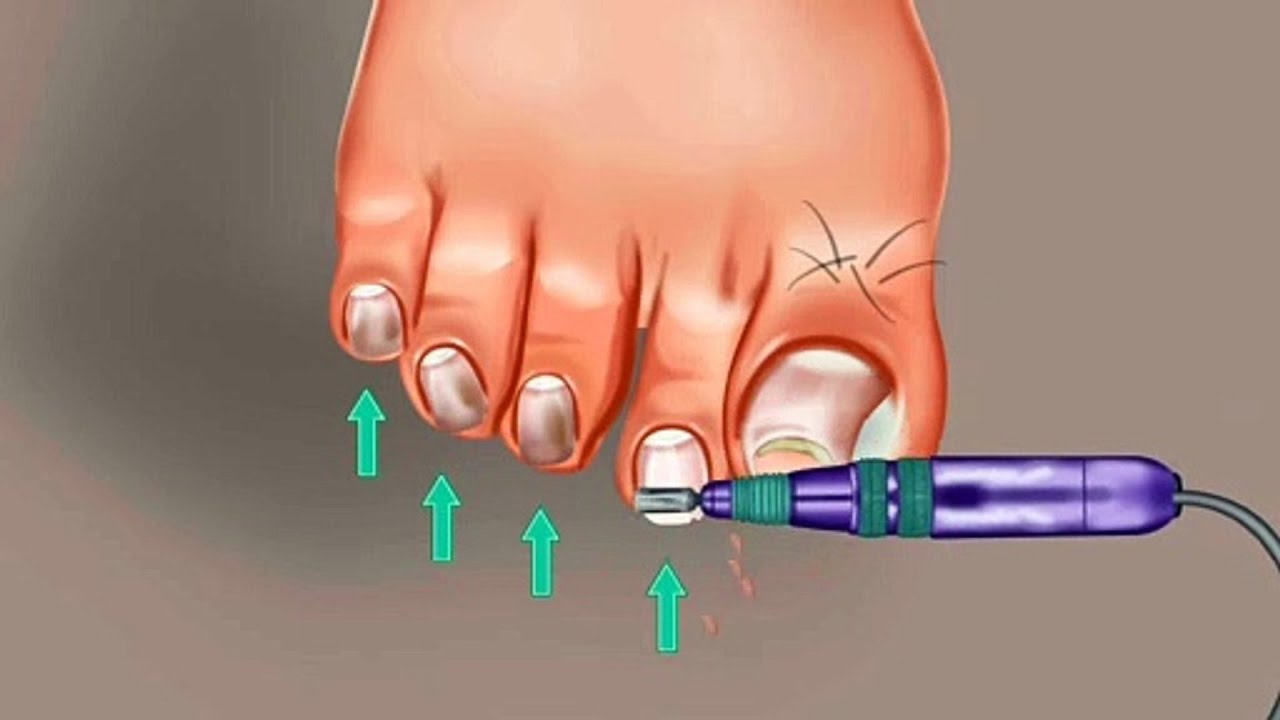 ASMR coolness | Ingrown Toenails removal ASMR Big ASMR NK video ...