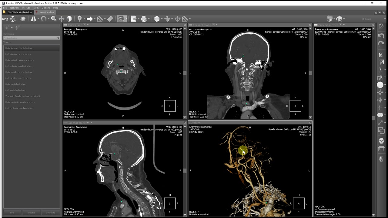 Carotide vessels analysis with dual scan bone removal - YouTube