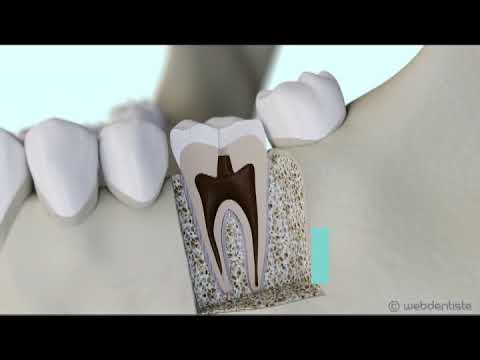 Protocole de dévitalisation d'une dent ou traitement endodontique - YouTube
