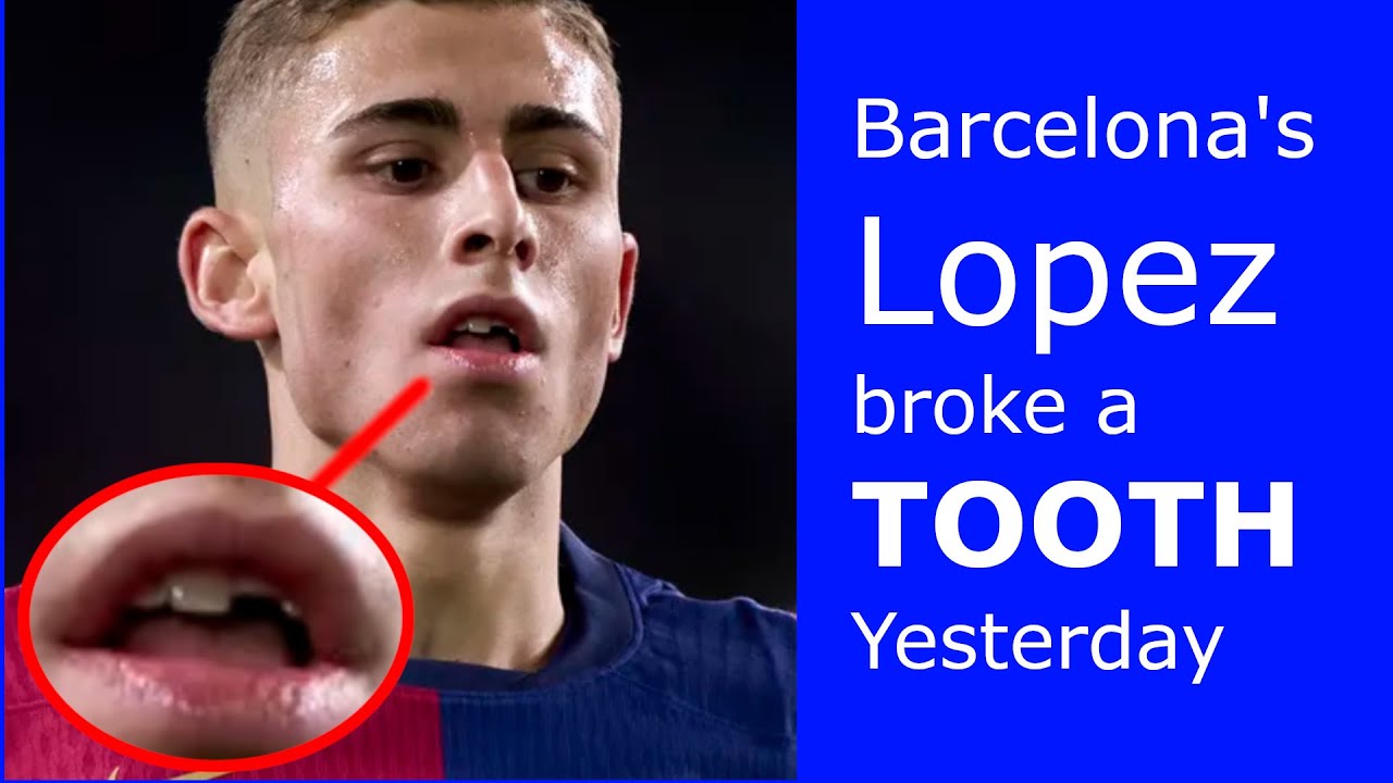 🦷 Barcelona's Lopez broke a TOOTH December 15th, 2024 (that's 10 days ...