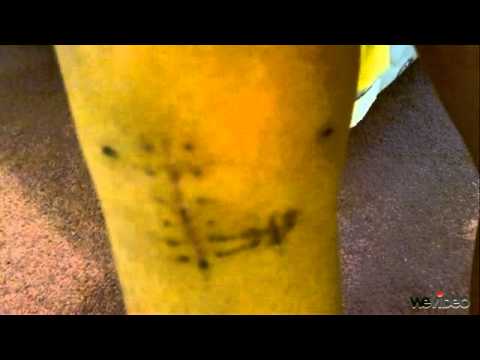 Scar from ACL reconstruction + LARS - YouTube