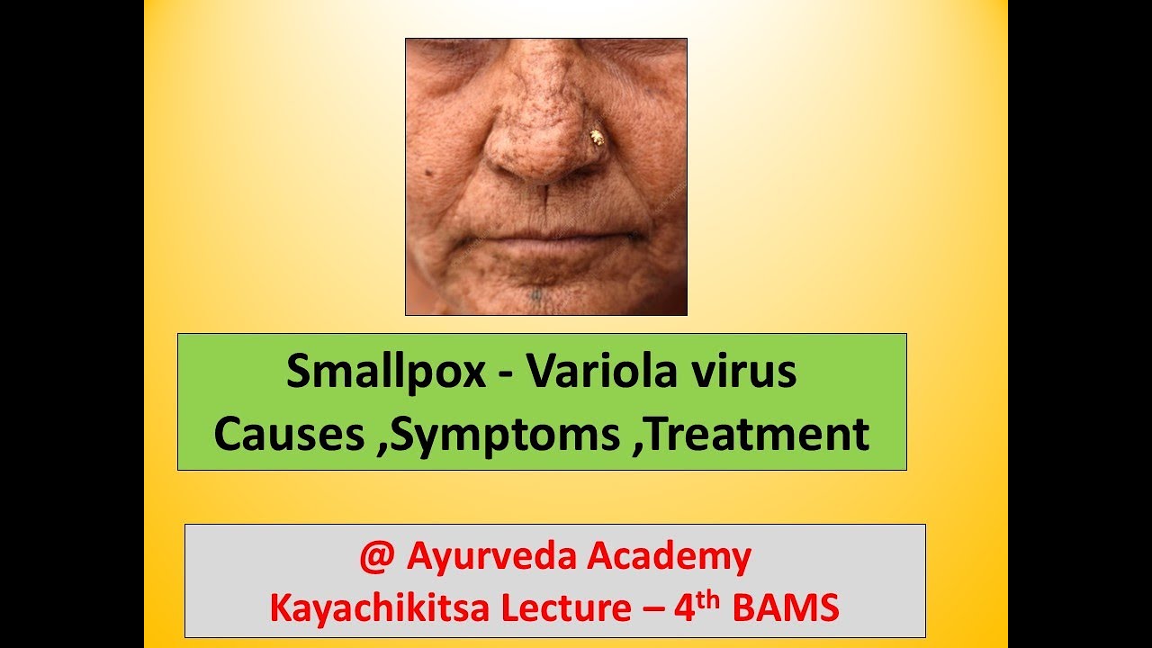 Smallpox – causes ,symptoms ,Diagnosis ,Treatment l Variola virus l ...