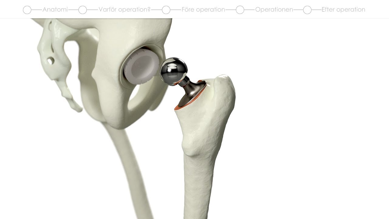 Patientfilm om höftledsplastik - YouTube