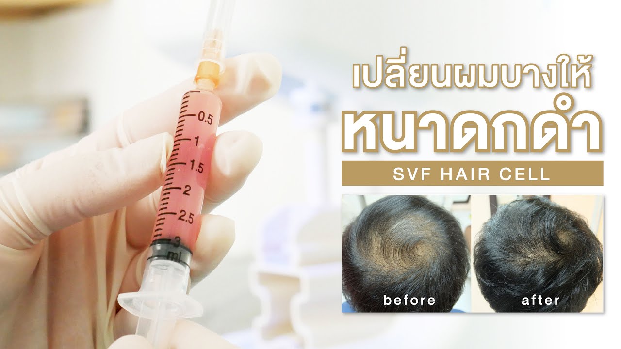 เปลี่ยนผมบางให้หนาดกดำด้วย SVF HAIR CELL - YouTube