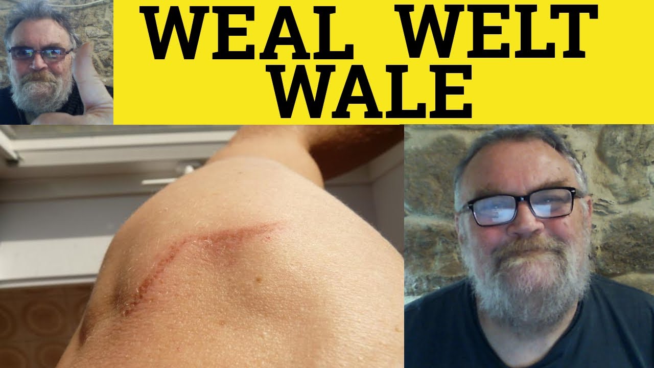 🔵 Weal Meaning - Welt Examples - Wale Defined - Weal Definition - Welt ...