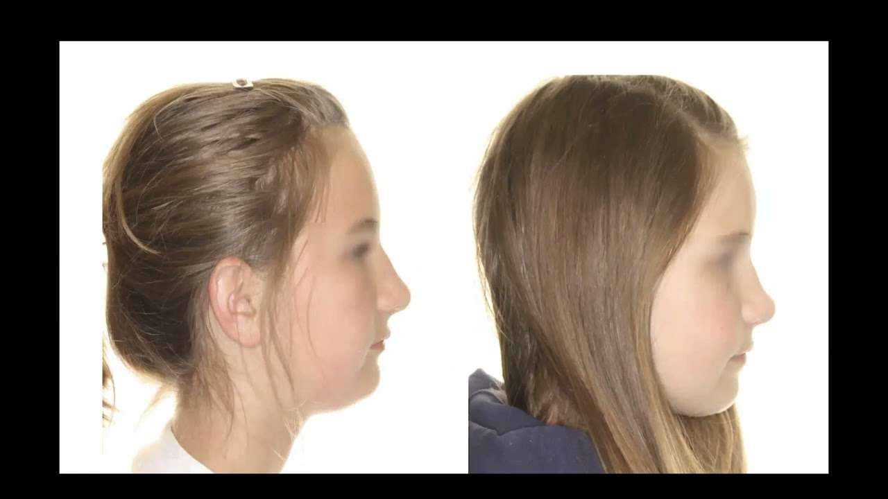 Maxillomandibular Advancement for OSA: Felonies and Misdemeanors ...