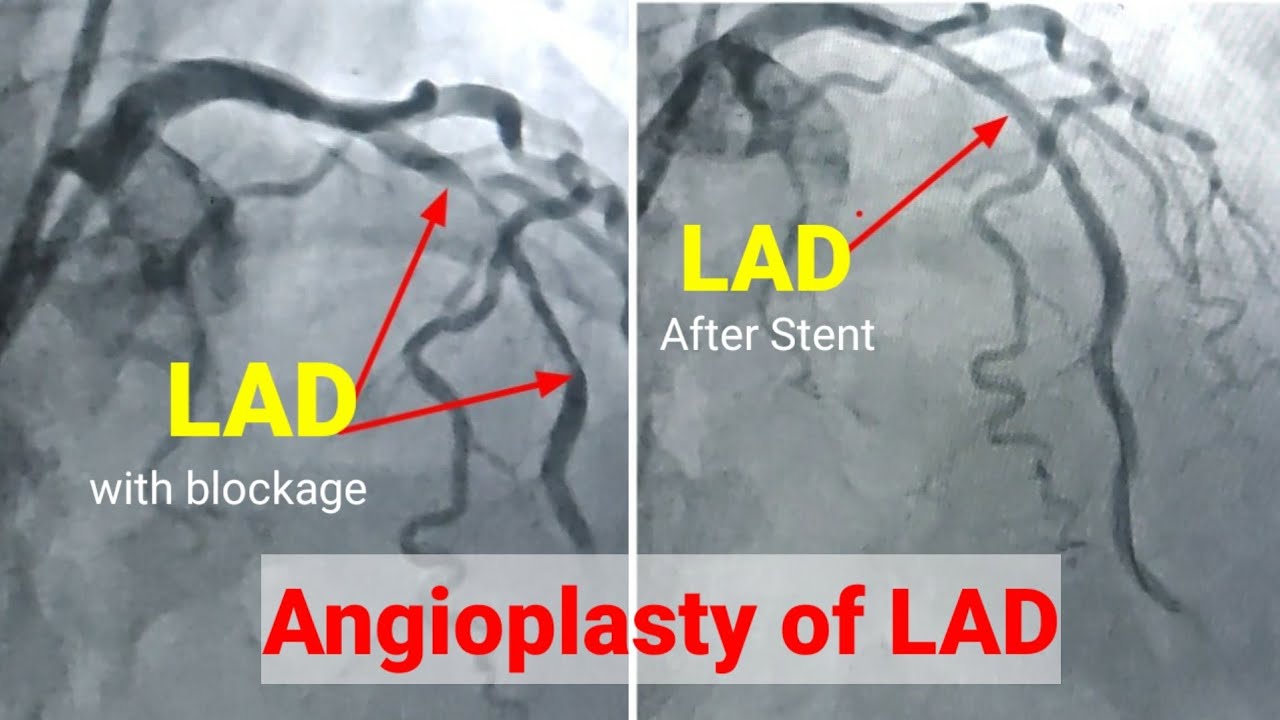 Angioplasty ll Angioplasty procedure(Radial access), Stenting of LAD ...