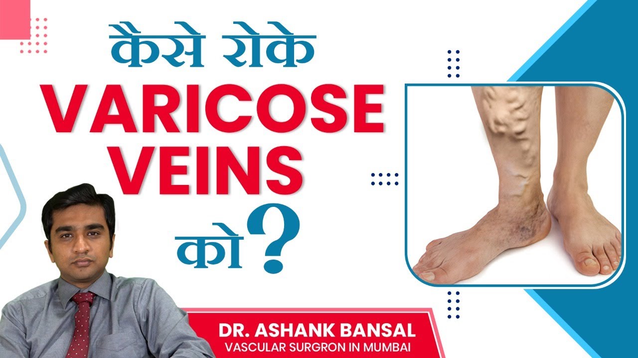 कैसे रोके वैरिकोज़ वेन को ? | Dr. Ashank Bansal - YouTube