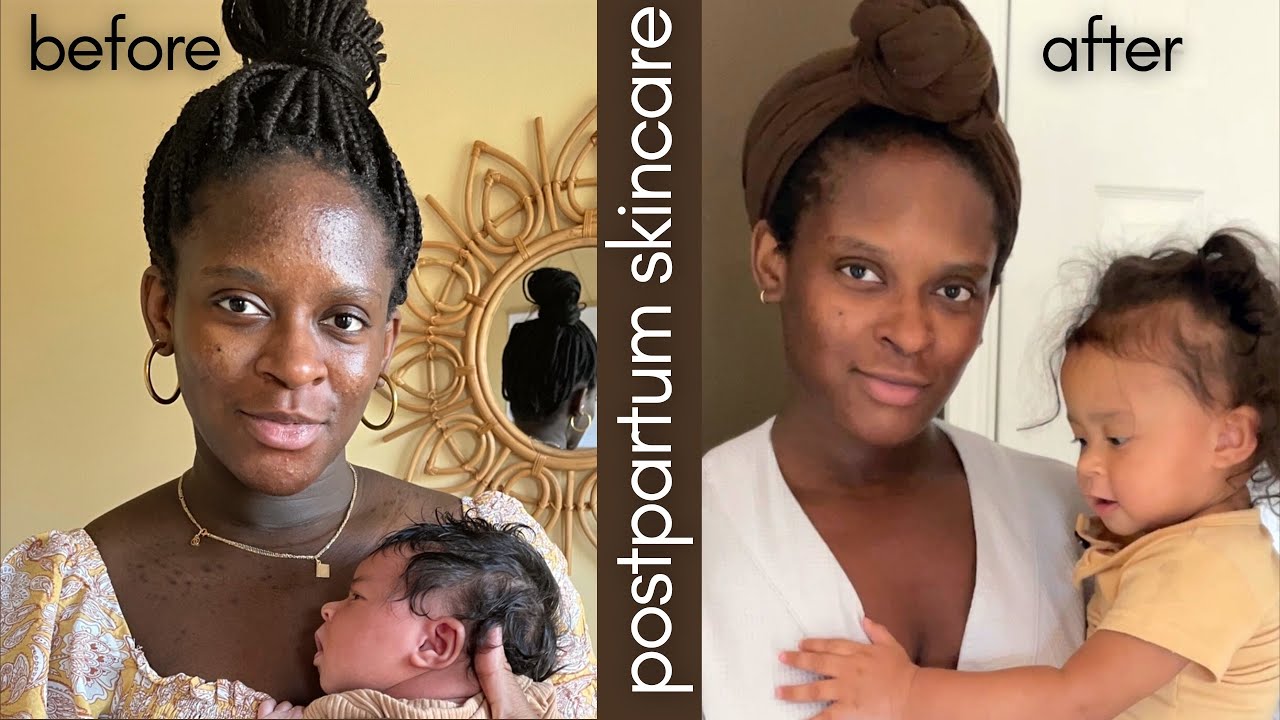 how i cleared my skin postpartum | fall skincare routine - YouTube