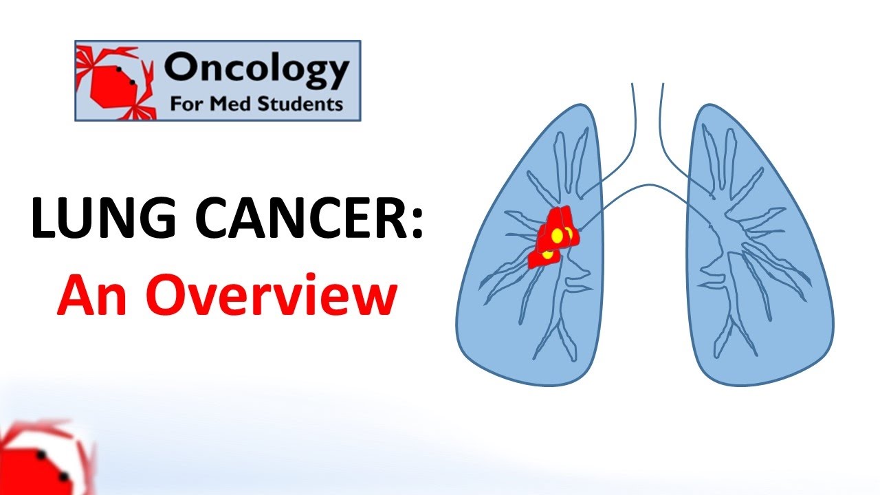 Lung Cancer: An Overview - YouTube