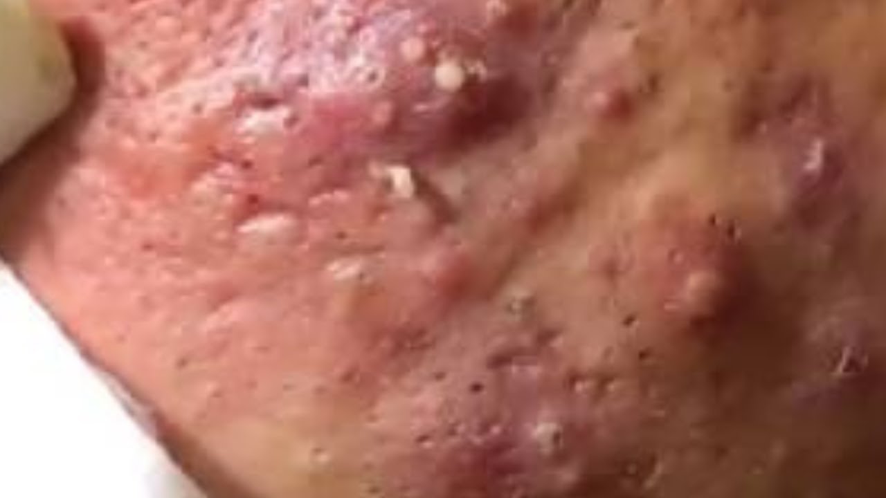 BIG & NASTY BLACKHEADS, PIMPLES, MILIA (Extractions) NOSE & CHEEKS ...