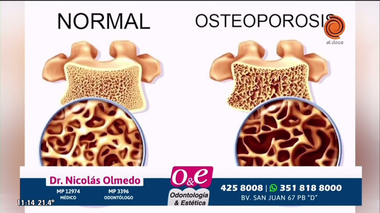 Todo lo que debés saber sobre los bifosfonatos - YouTube