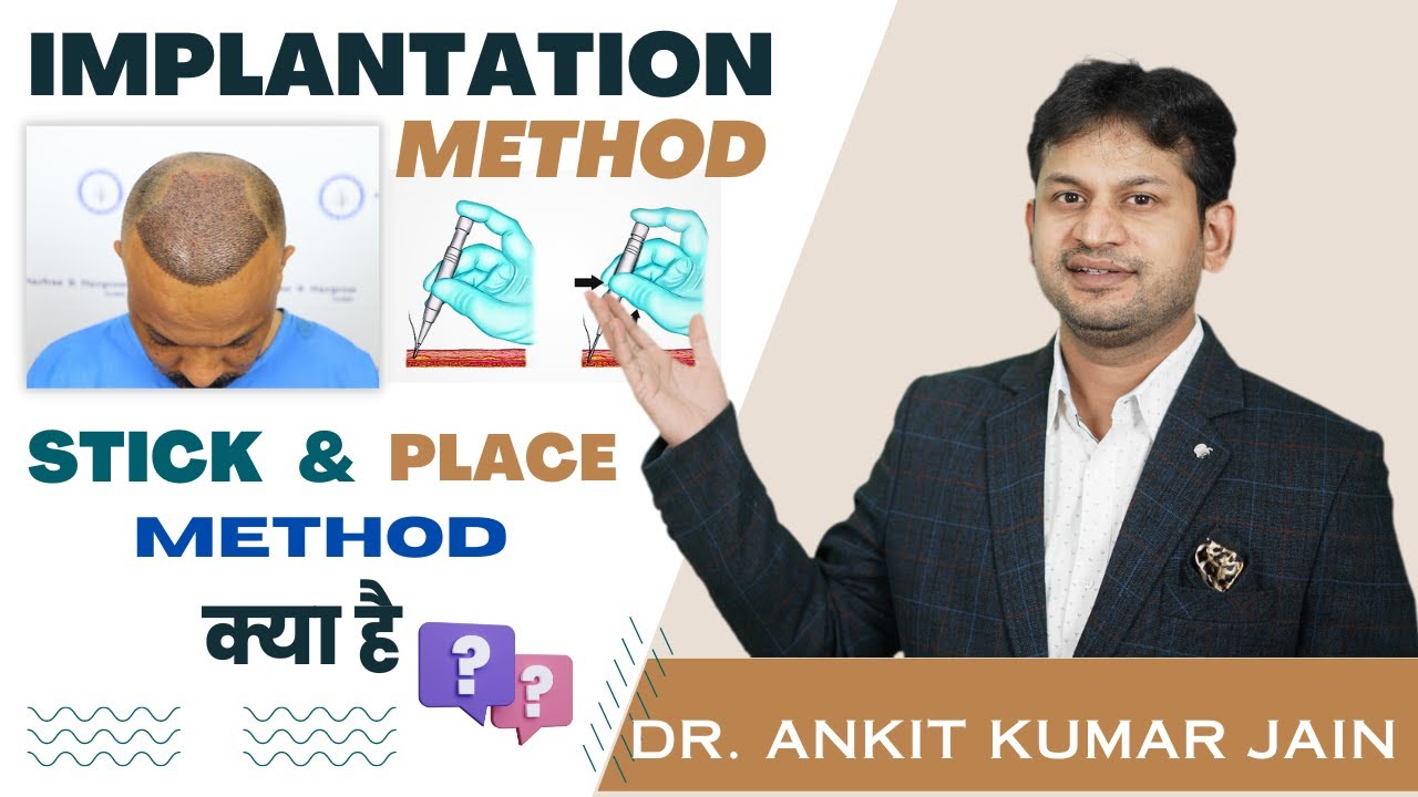 Implantation Method 02nd || Stick & Place Method || - YouTube
