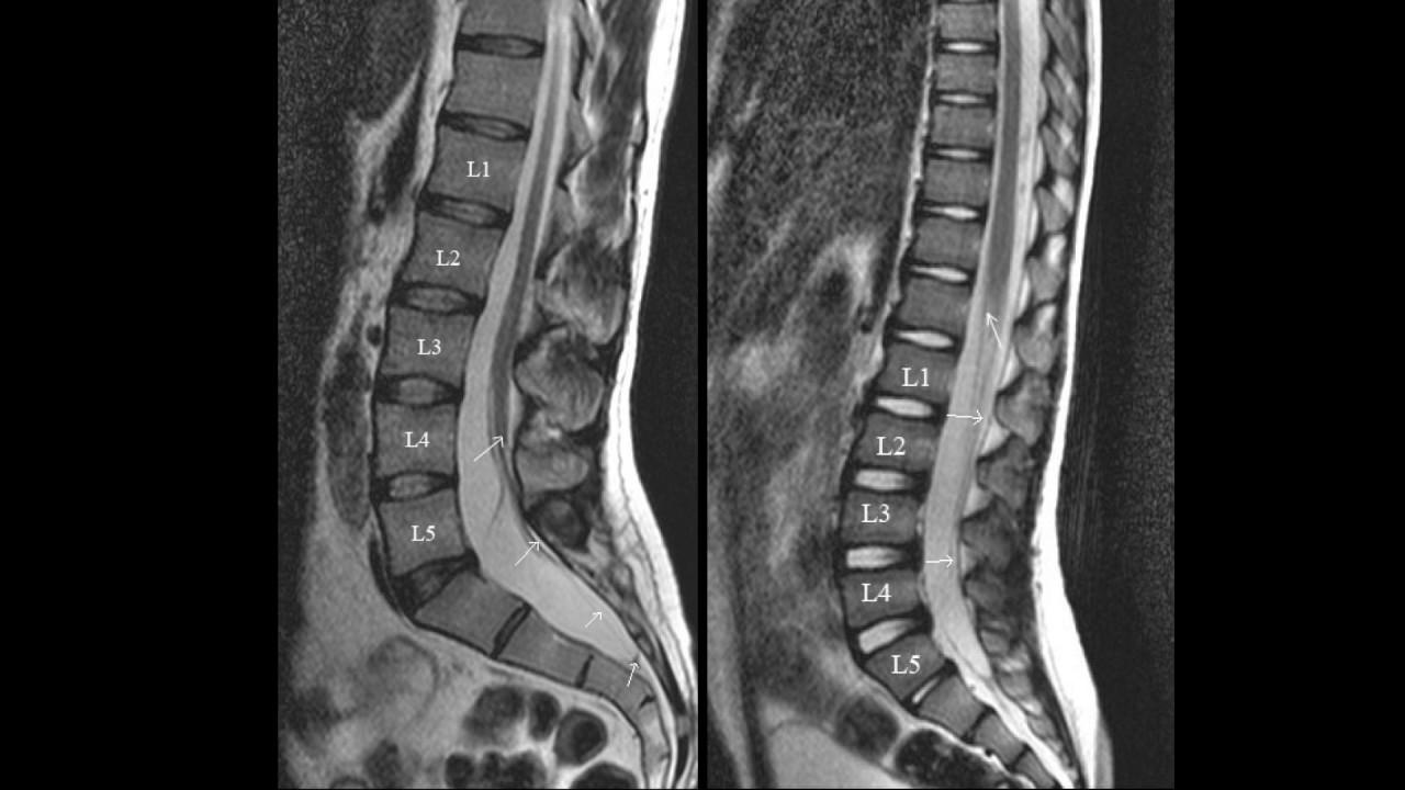 Zakotwiczenie rdzenia. Tethered cord. Operacja przecięcia nici końcowej ...