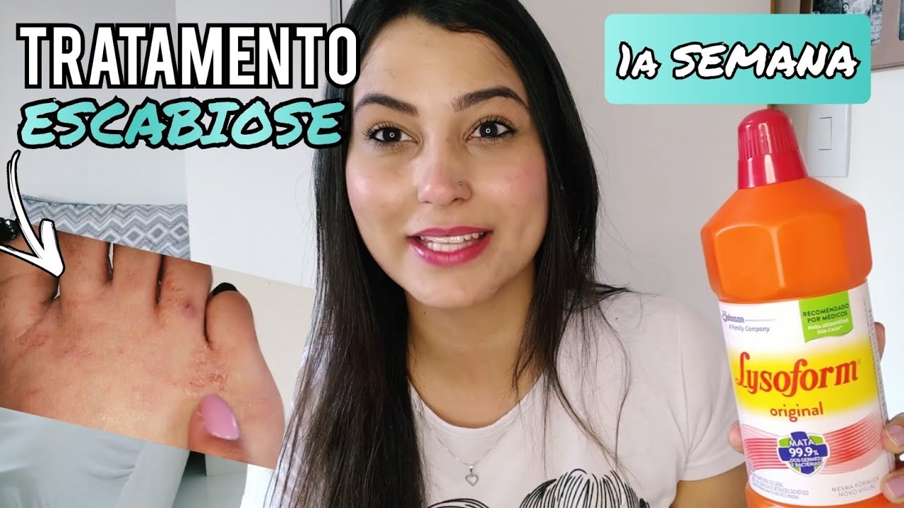 INICIEI O TRATAMENTO CONTRA ESCABIOSE | SARNA HUMANA | 1a SEMANA | CRIS ...