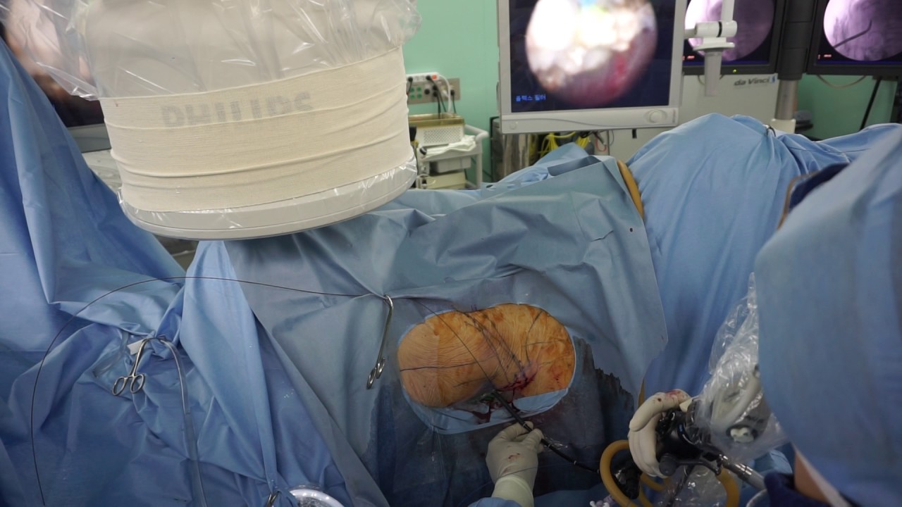 Rt ECIRS for a large renal pelvis stone and a satellite stone in the ...