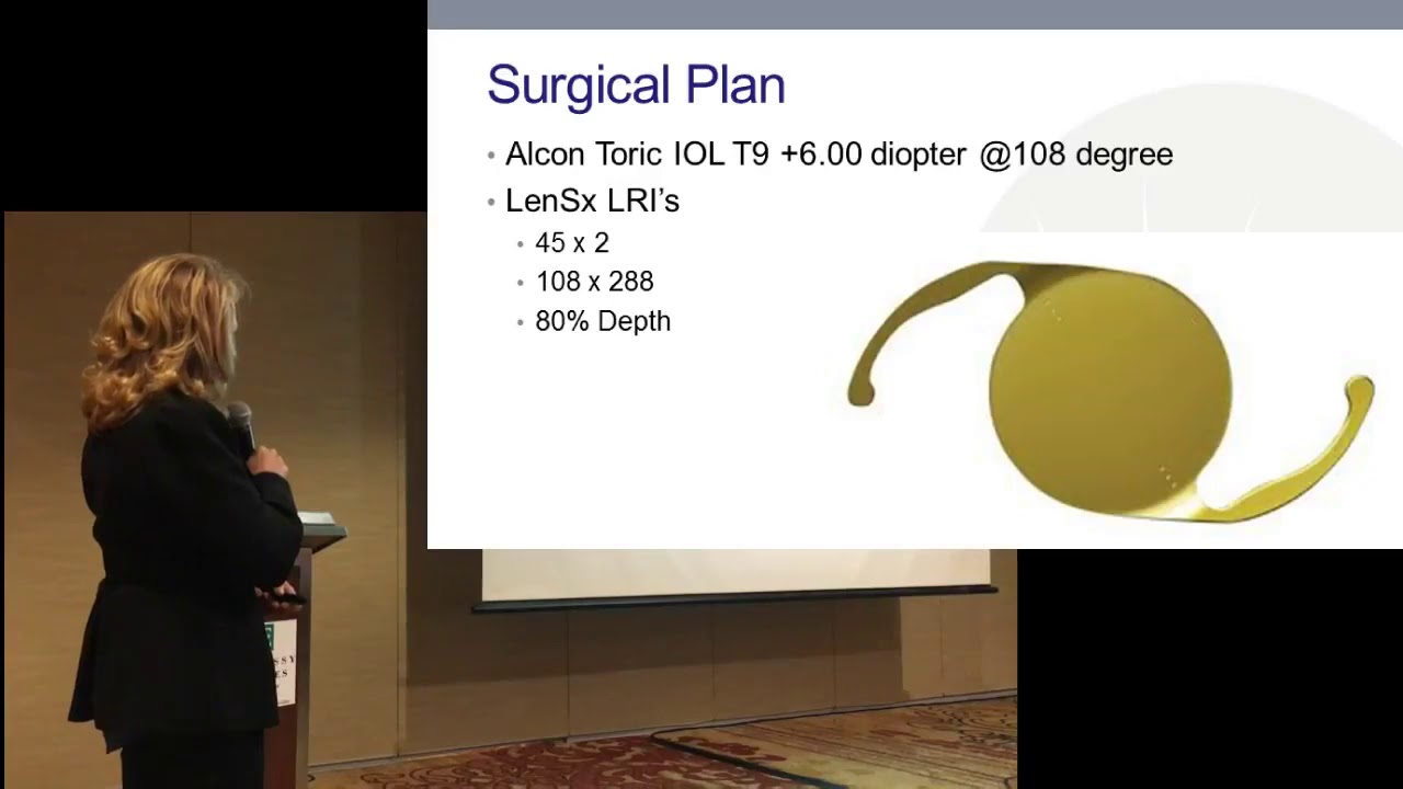 ASCRS18 Cathleen McCabe Better Toric Outcomes - YouTube