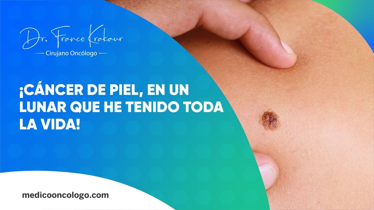 ¡Cáncer de piel, En Un Lunar Que He Tenido Toda La Vida! | Dr. Franco ...