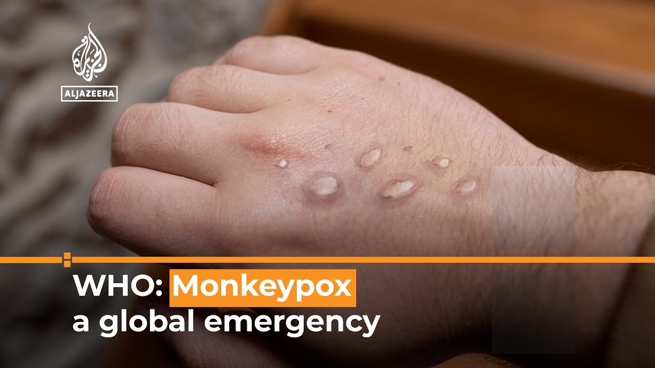 WHO declares monkeypox a global health emergency | Al Jazeera Newsfeed ...