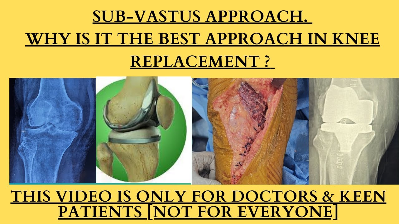 SUB VASTUS APPROACH. IS IT "THE BEST OF ALL" APPROACH FOR KNEE ...
