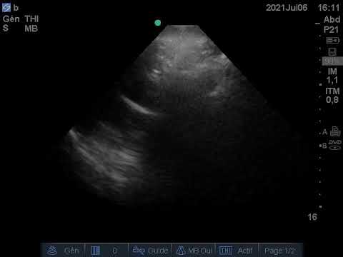 Dilatation pyélocalicielle chronique Échographie - YouTube