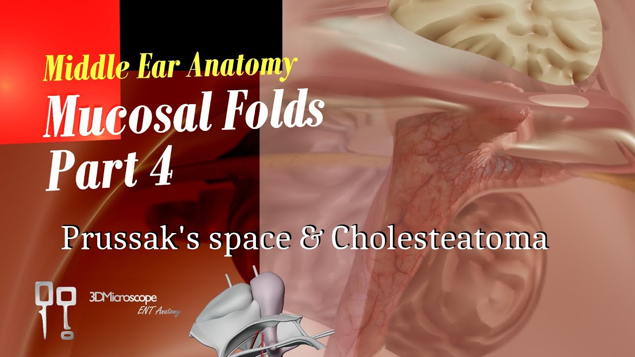 Prussak's space and Cholesteatoma - Middle Ear Anatomy - Mucosal Folds ...