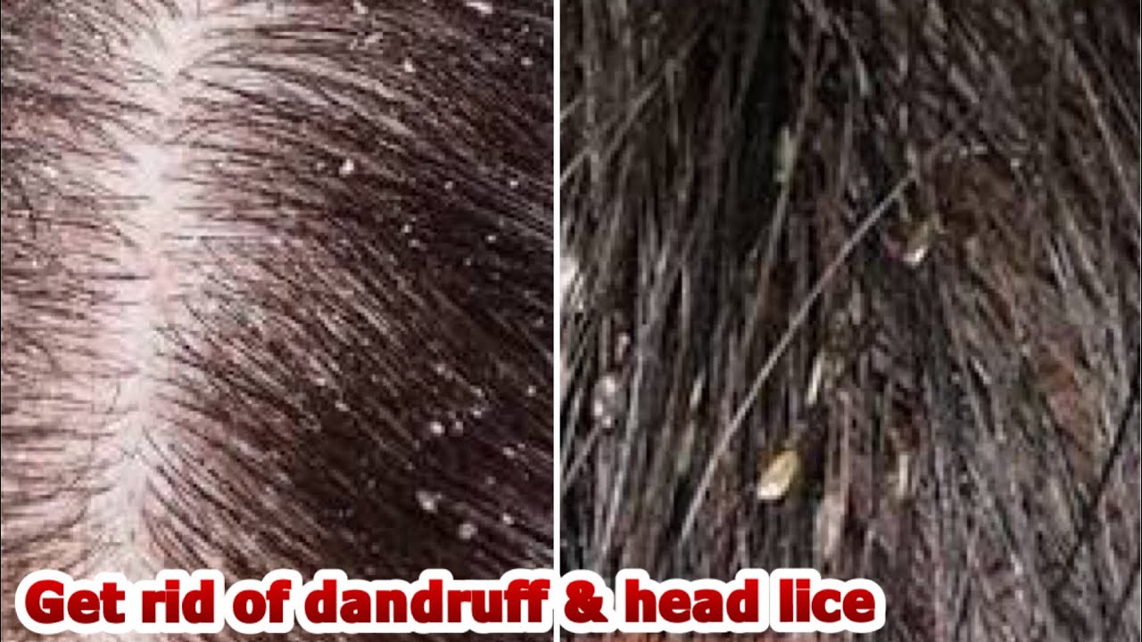 Head Lice Vs Dandruff Pictures