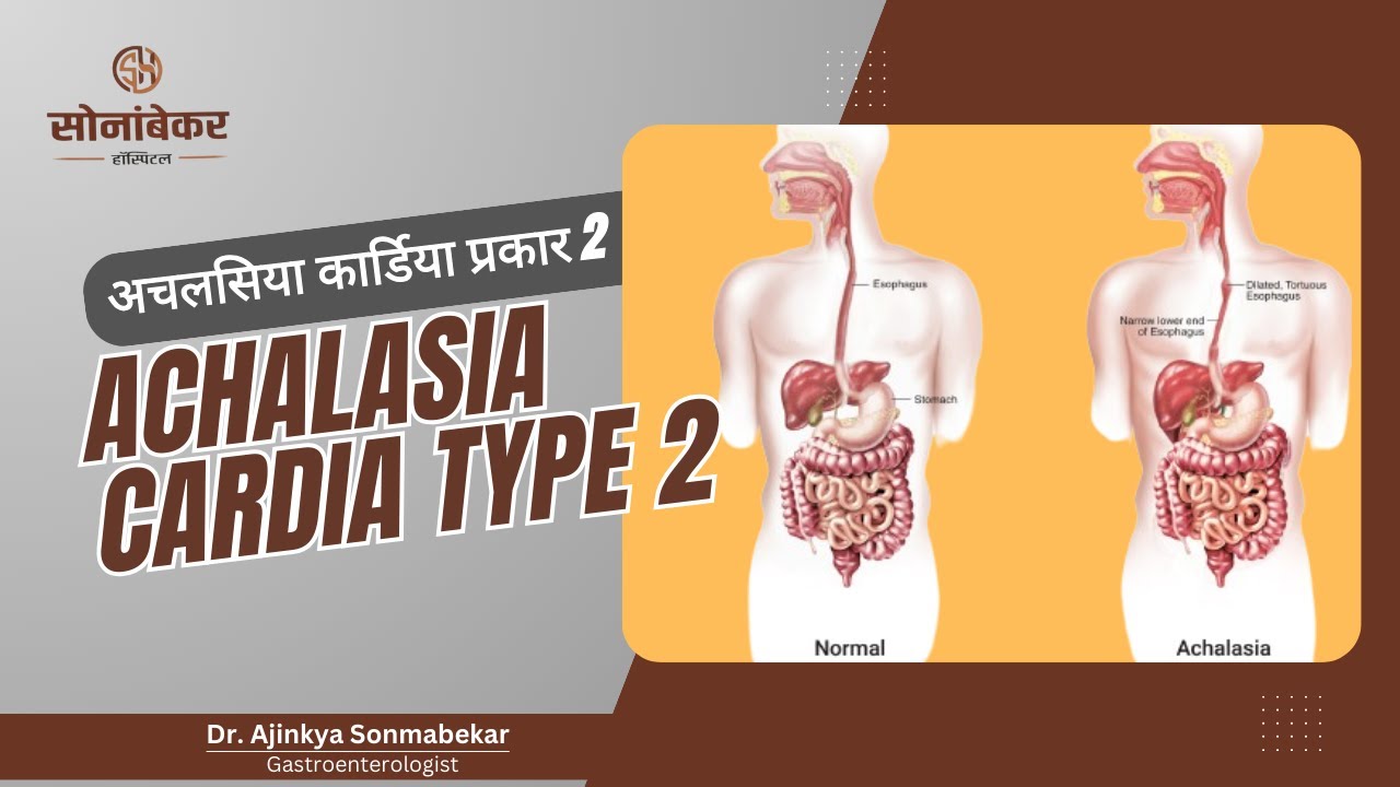 Understanding Achalasia Cardia Type 2: Insights from Dr. Ajinkya ...