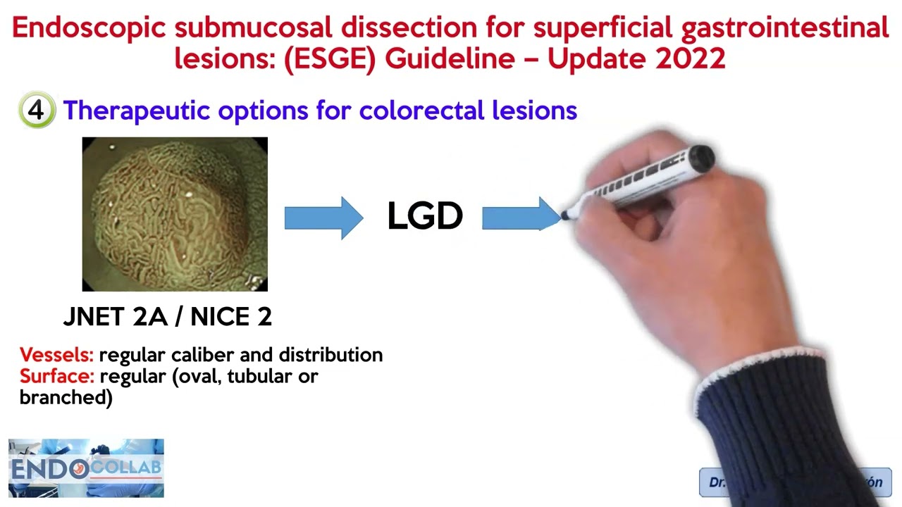 Endoscopic submucosal dissection for superficial ...