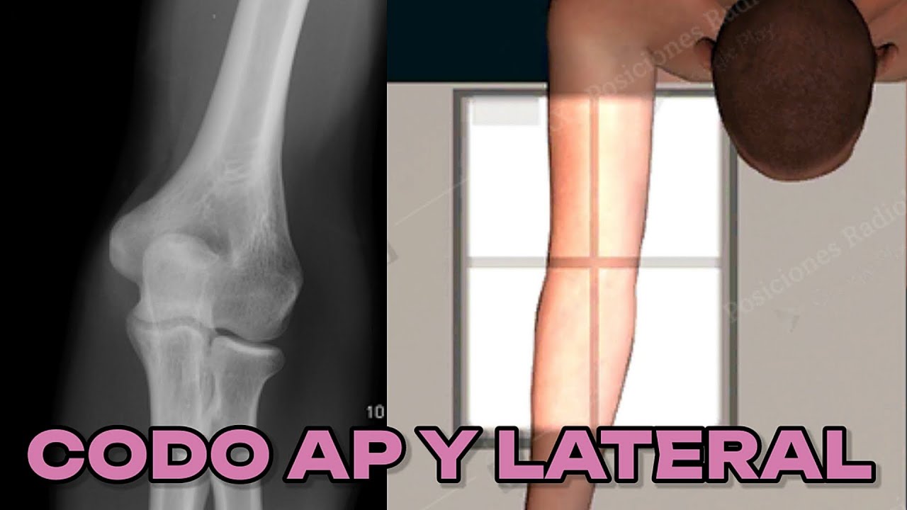 RADIOGRAFÍA DE CODO AP Y LATERAL (MANUAL DE BOLSILLO) #12 - YouTube