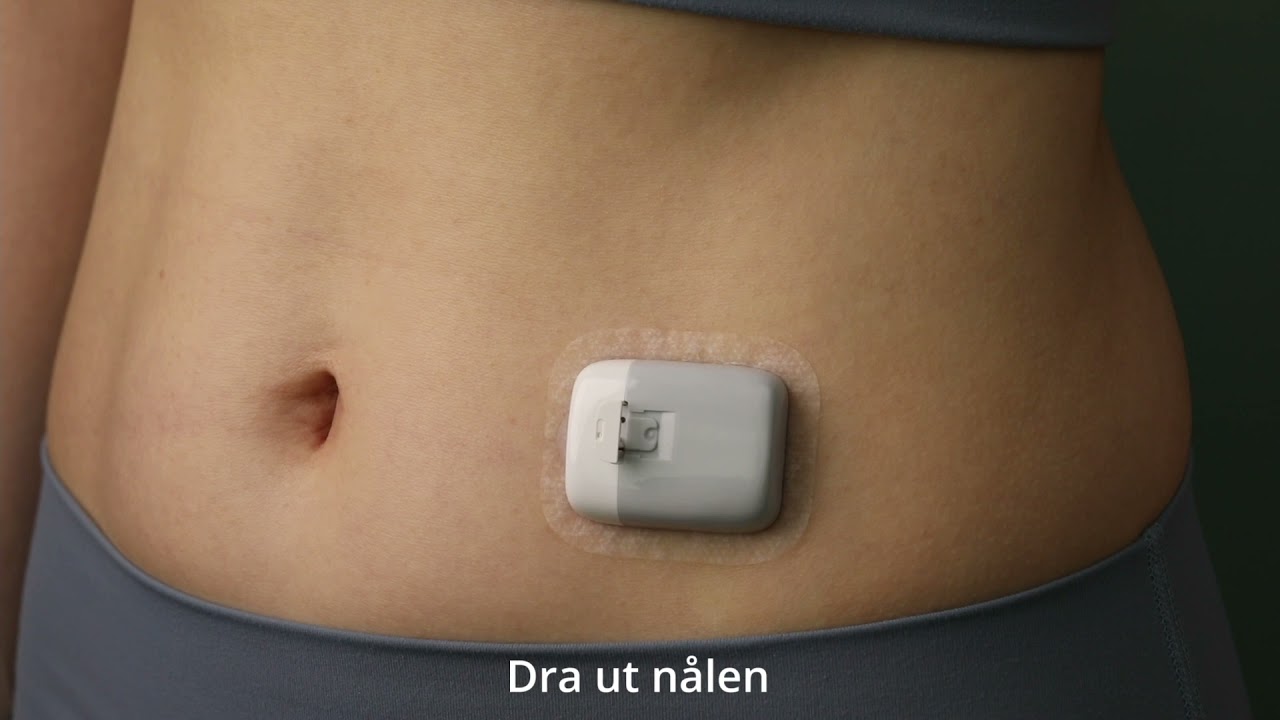 How to remove the Nano Patch Pump Nano Pump & PDM (Swedish) - YouTube