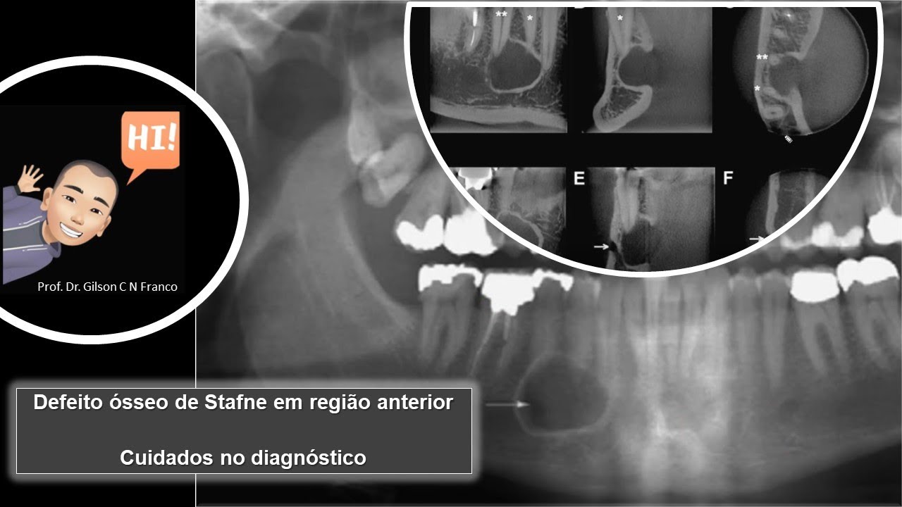 Defeito ósseo De Stafne - RETOEDU