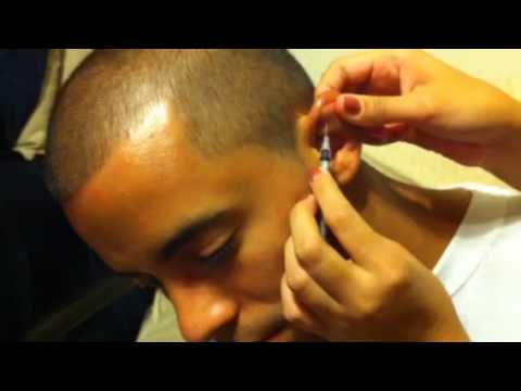 How To Drain Cauliflower Ear - YouTube