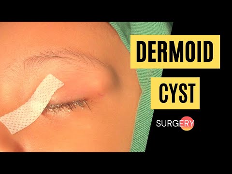 DERMOID CYST EXCISION - YouTube
