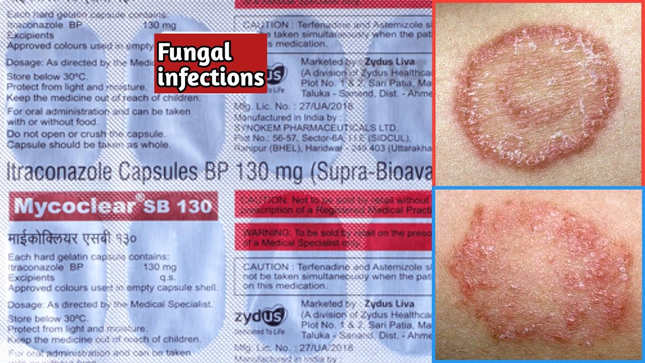 Fungal infections control with Mycoclear SB 130 ll itraconazole - YouTube